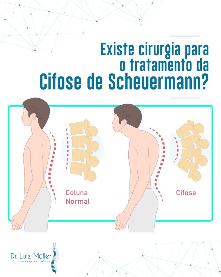 Existe cirurgia para o tratamento da Cifose de Scheuermann? – Luiz Muller